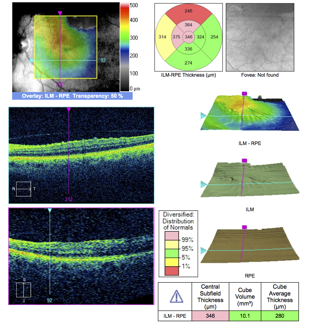 Educational Series: Epiretinal Membrane - Johnson Optometric